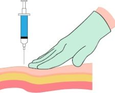 7.5 Intramuscular Injections – Clinical Procedures for Safer Patient Care