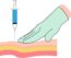 7.5 Intramuscular Injections – Clinical Procedures for Safer Patient Care