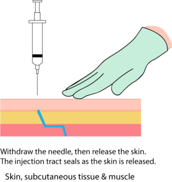 7.5 Intramuscular Injections – Clinical Procedures for Safer Patient Care