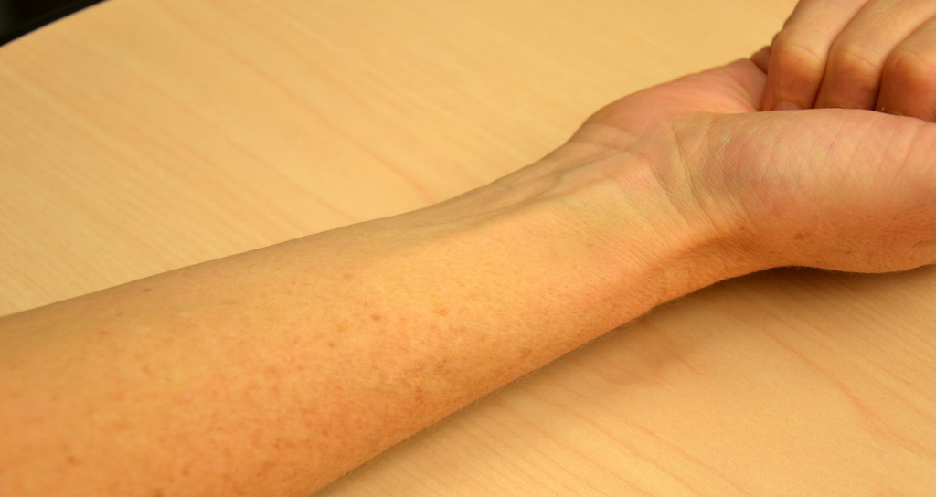 7.3 Intradermal Injections – Clinical Procedures for Safer Patient Care