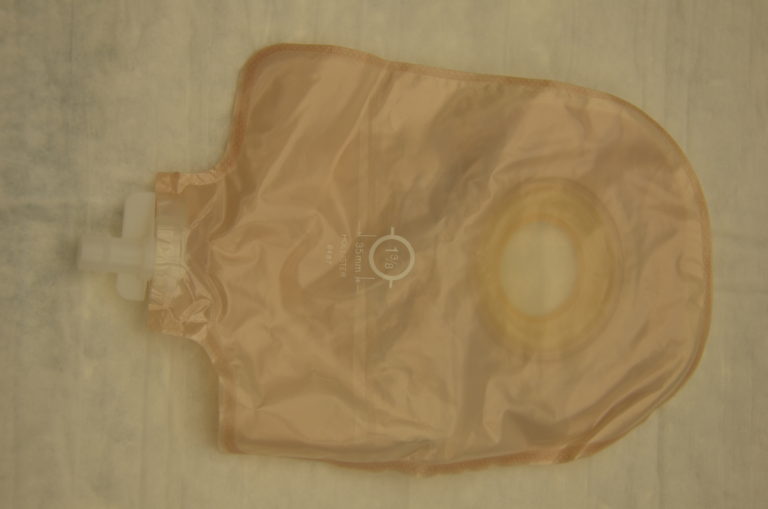 11.2 Ostomy Care – Clinical Procedures for Safer Patient Care