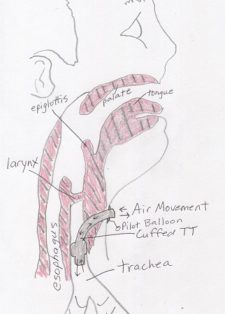 10.5 Tracheostomies – Clinical Procedures for Safer Patient Care