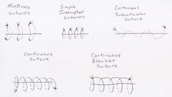 4.7 Suture Removal – Clinical Procedures for Safer Patient Care