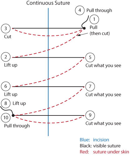 4.7 Suture Removal – Clinical Procedures for Safer Patient Care