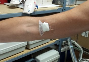 8.9 Removal of a PVAD-Short, Midline Catheter, Percutaneous Non ...