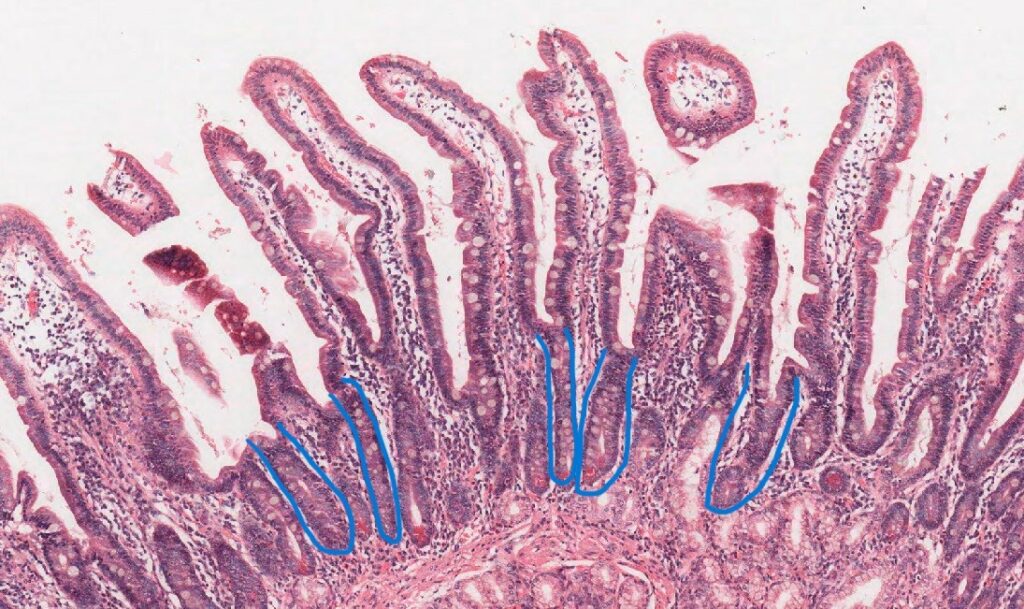 A New Learner’s Guide to Epithelial Tissue: Glandular Epithelia – Pathology