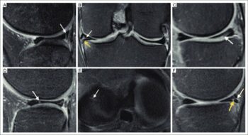 Menisci Tears – Pathophysiology