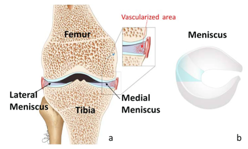 Menisci Tears – Pathophysiology