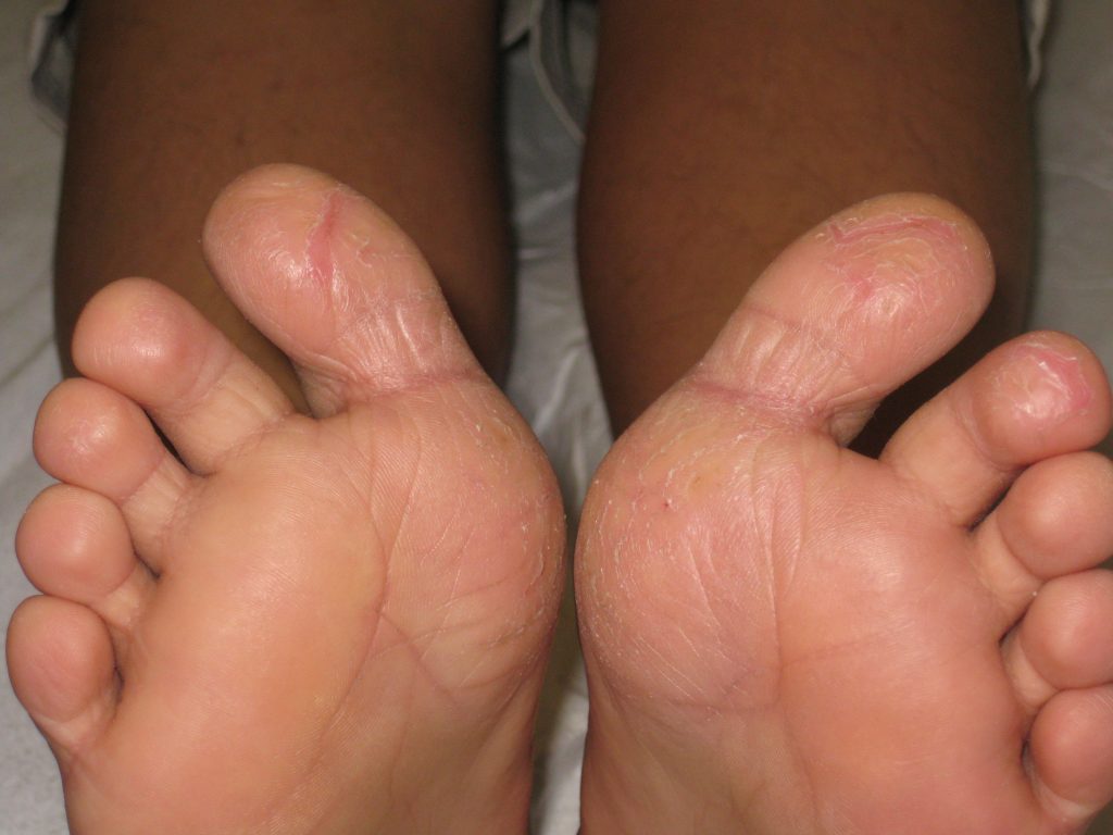 Juvenile Plantar Dermatosis – Pediatric Dermatology