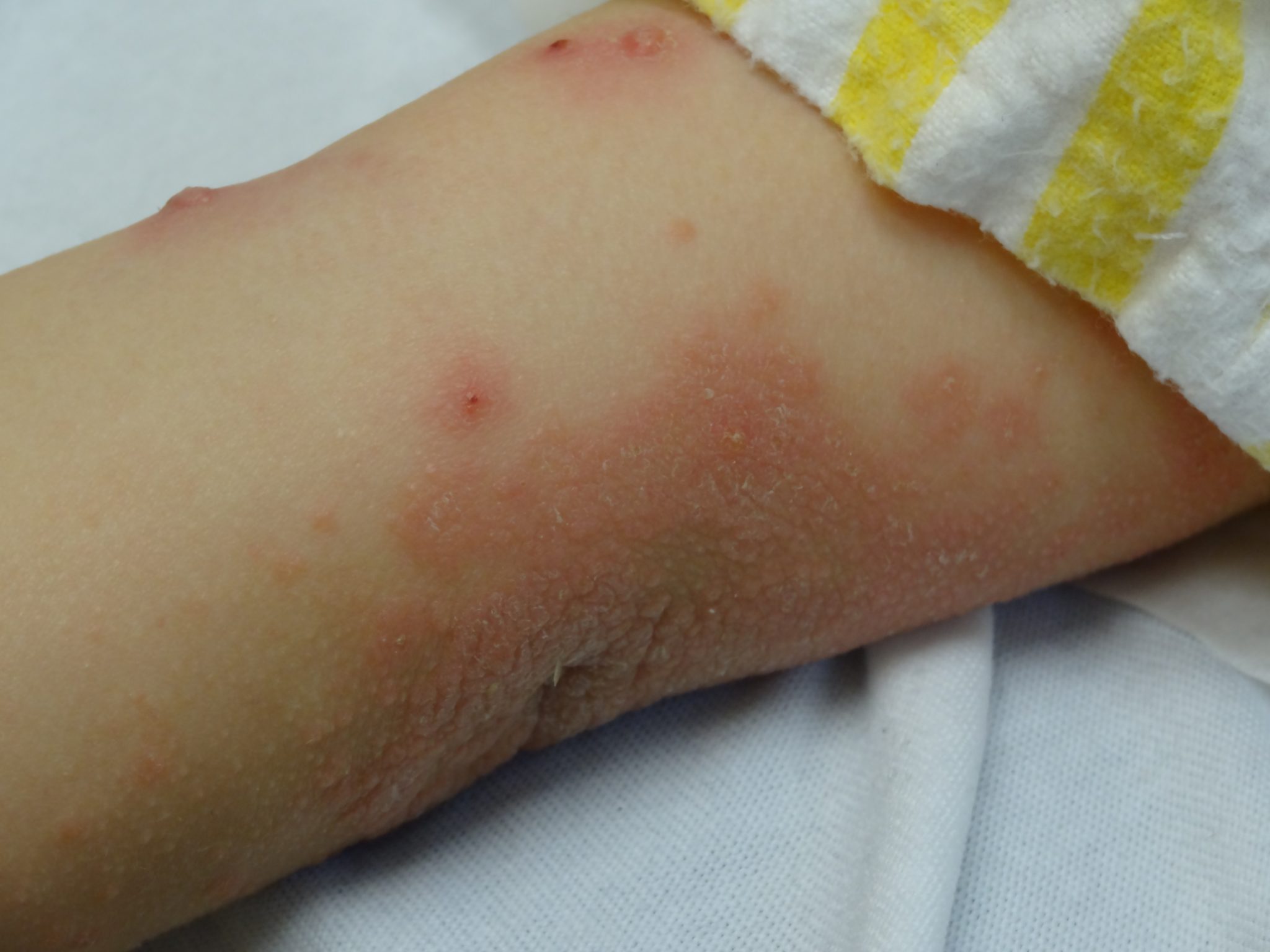 Id Reaction (Autosensitization) – Pediatric Dermatology