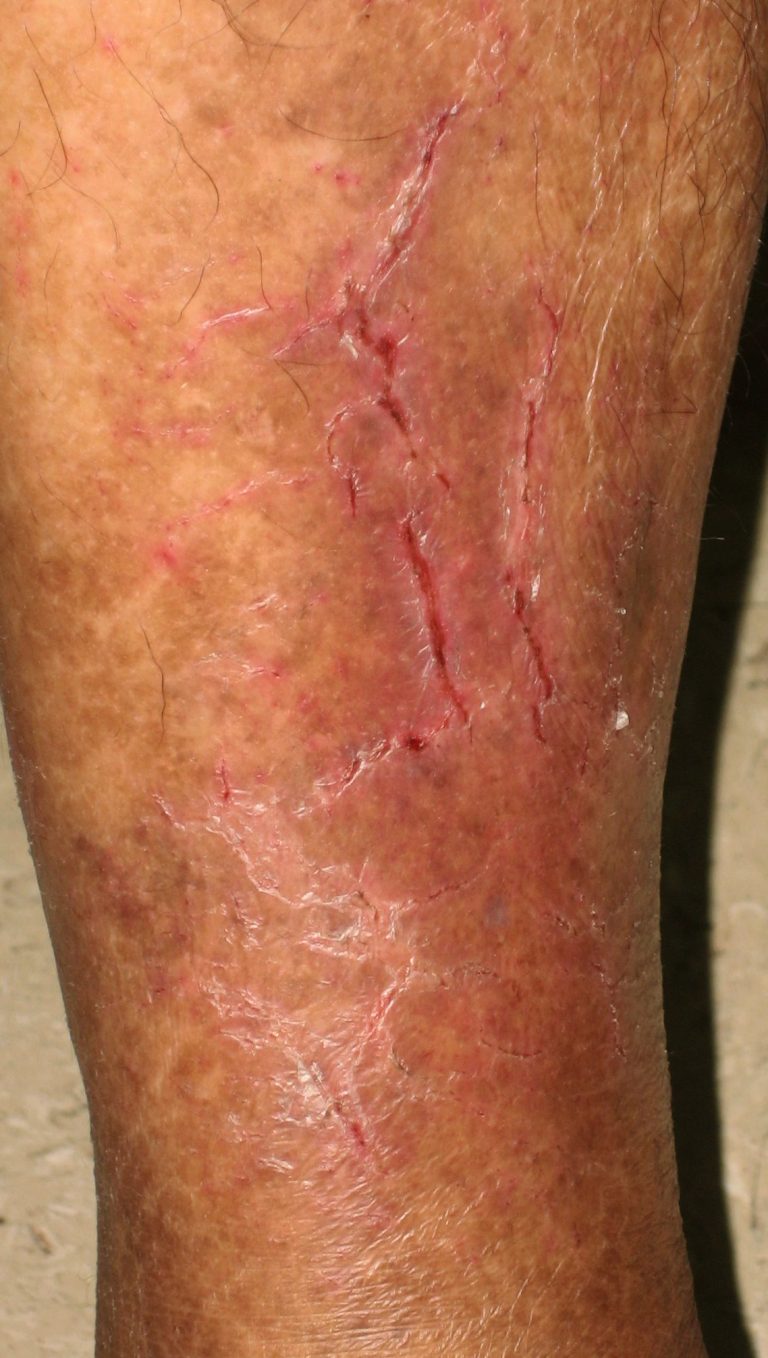 Asteatotic Dermatitis – Pediatric Dermatology