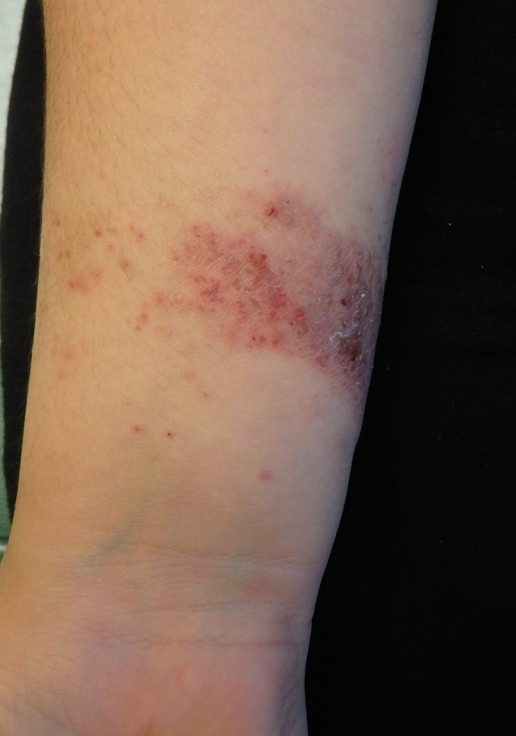 Contact Dermatitis – Pediatric Dermatology