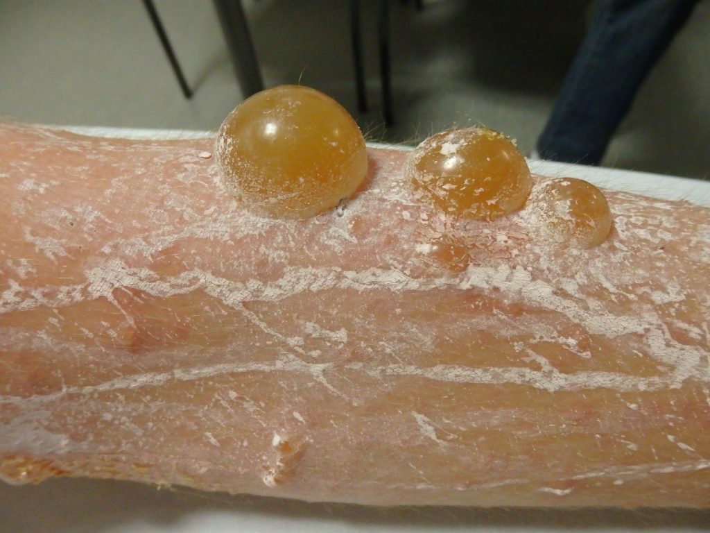 Contact Dermatitis – Pediatric Dermatology