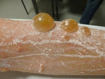 Contact Dermatitis – Pediatric Dermatology