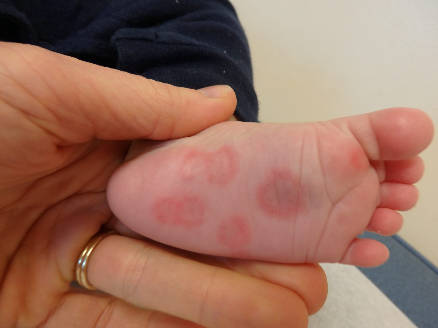 Potentially Concerning Skin Changes in Newborns – Pediatric Dermatology