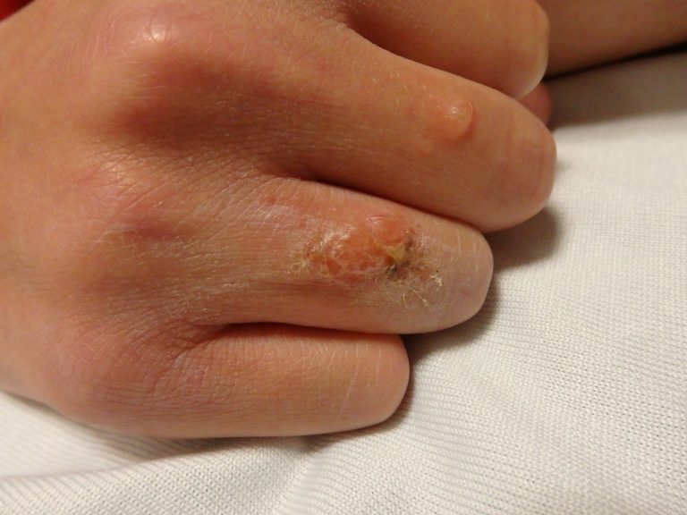 Contact Dermatitis – Pediatric Dermatology