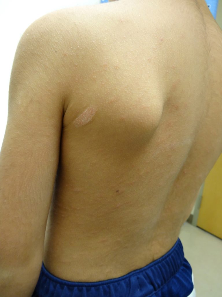 Pitryriasis Rosea – Pediatric Dermatology