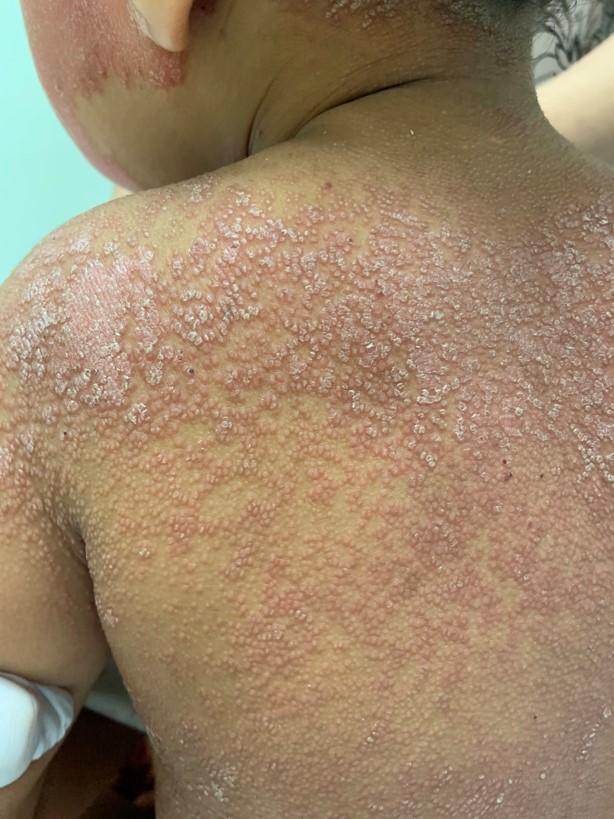 Pityriasis Rubra Pilaris – Pediatric Dermatology