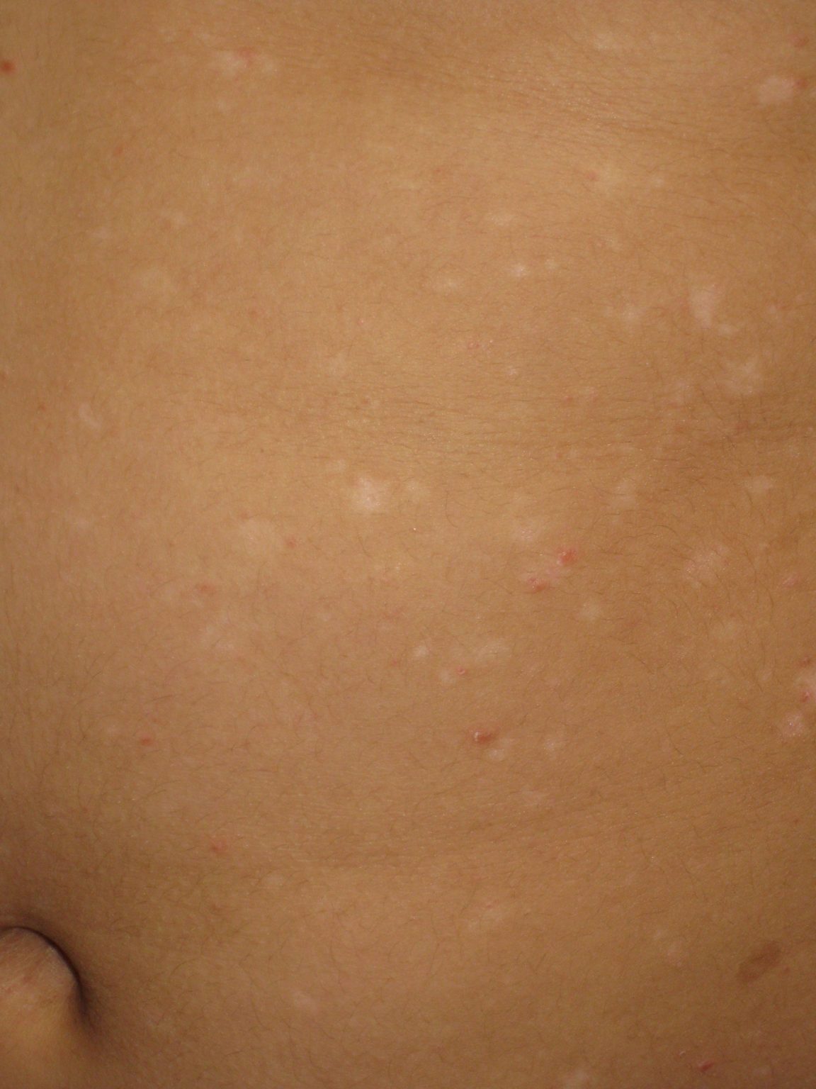 Pityriasis Lichenoides (PLC/PLEVA) – Pediatric Dermatology