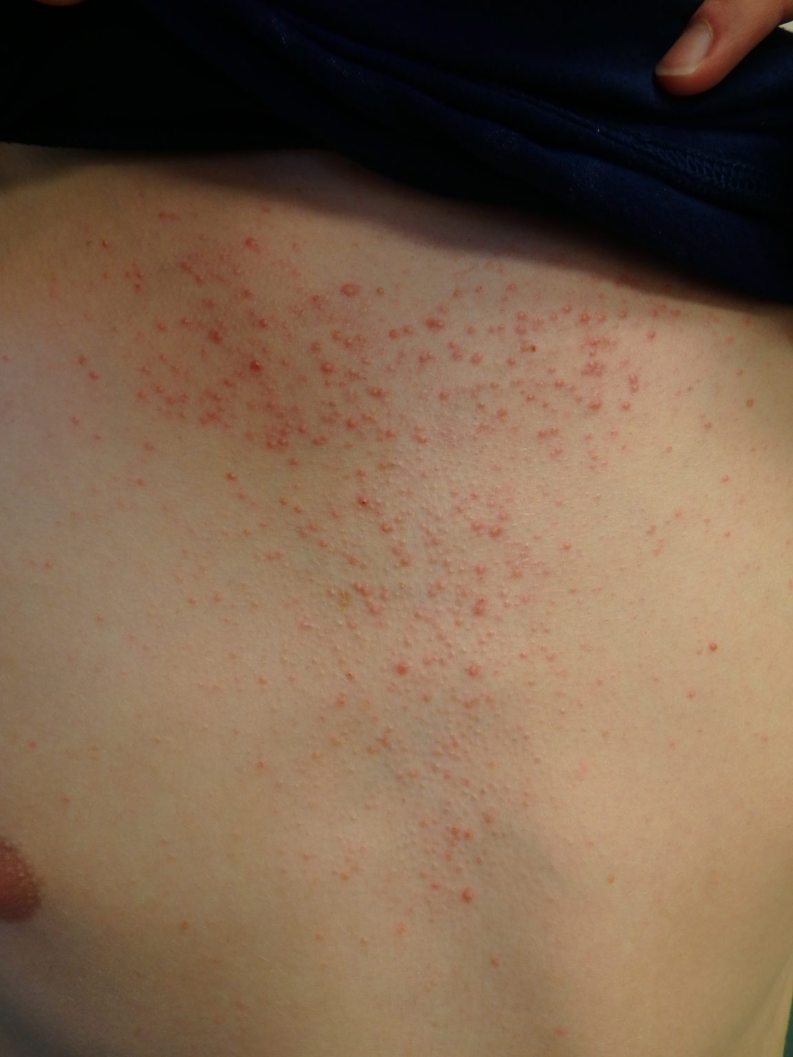 Acne Variants: Conglobata, Fulminans, and Medication-induced ...