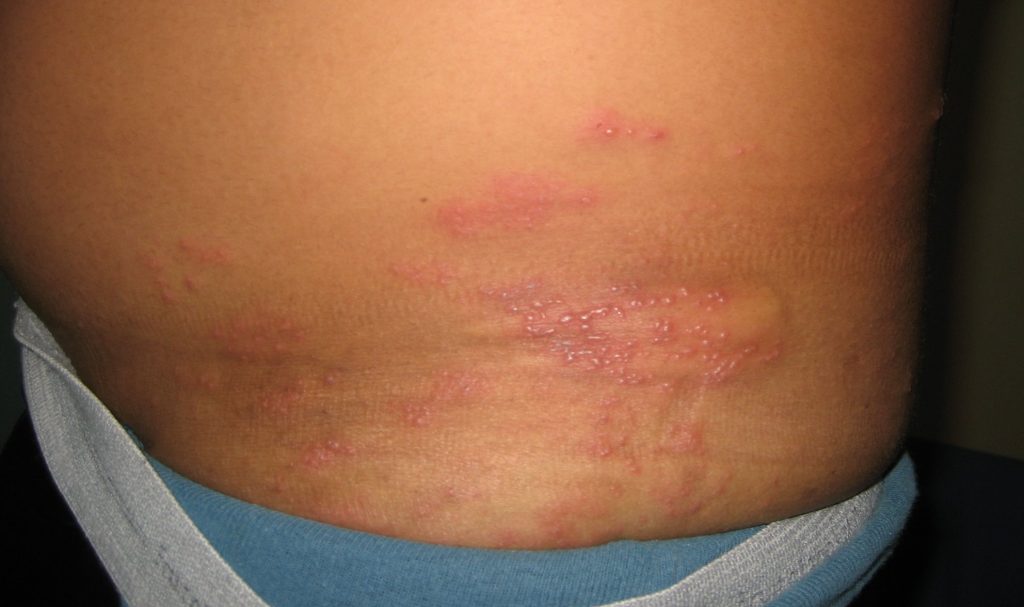 Viral Infections: Zoster (Shingles) – Pediatric Dermatology