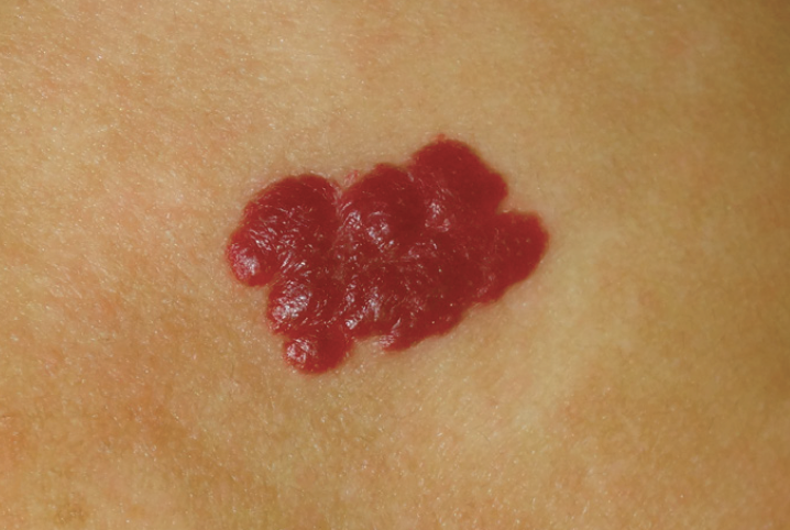 Vascular Tumors: Infantile Hemangioma – Pediatric Dermatology