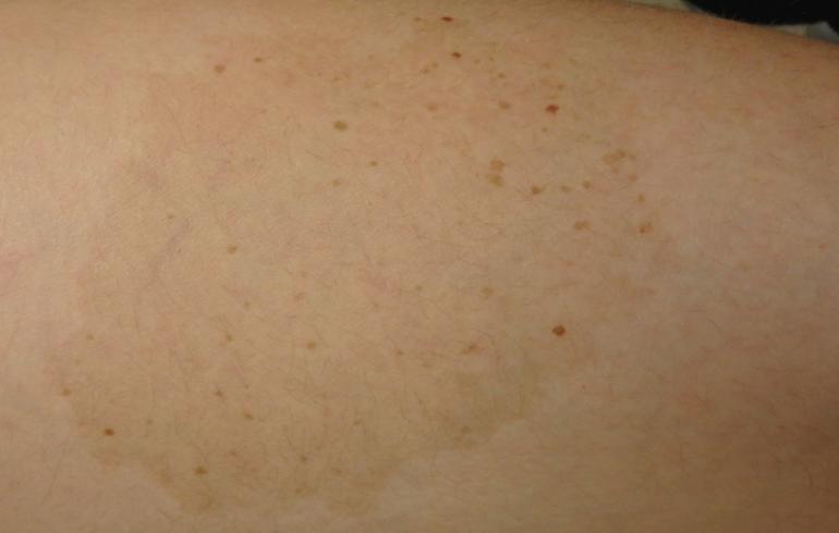 Other Birthmarks – Pediatric Dermatology