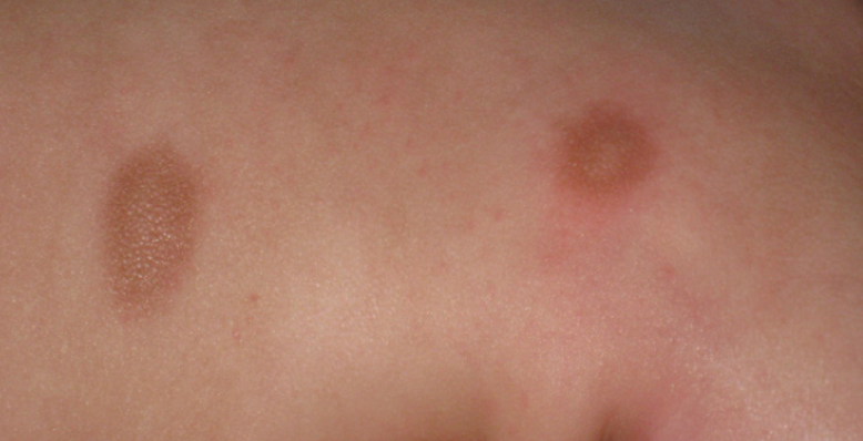 Mastocytosis – Pediatric Dermatology