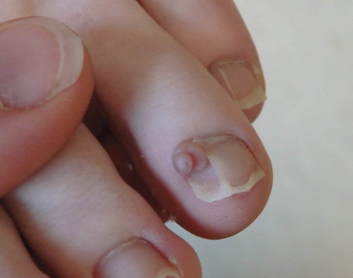 Genodermatoses: Tuberous Sclerosis – Pediatric Dermatology