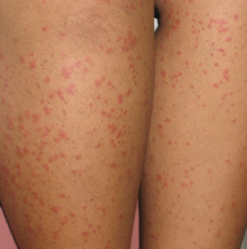 Vasculitis – Pediatric Dermatology