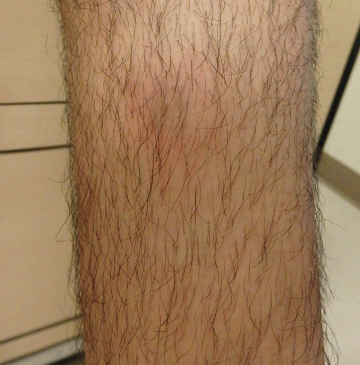 Erythema Nodosum – Pediatric Dermatology