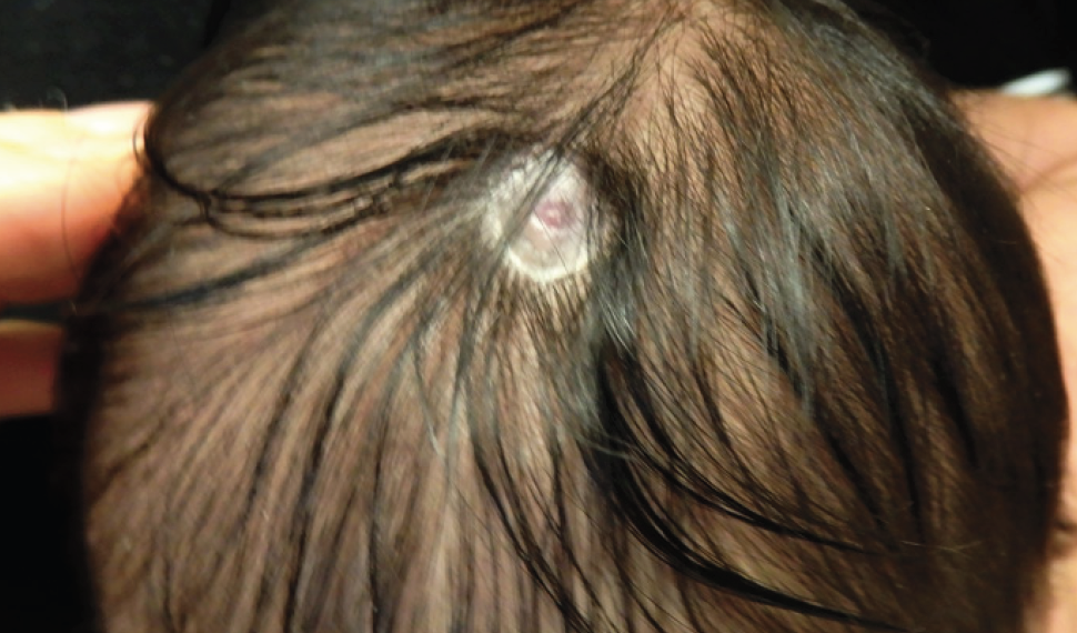 Localized Scarring Alopecia: Discoid Lupus – Pediatric Dermatology