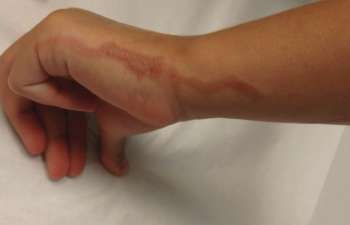 Sun-Induced Conditions: Phytophotodermatitis – Pediatric Dermatology