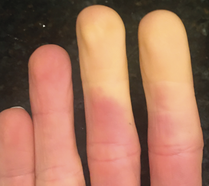 Cold-Induced Conditions: Raynaud’s Disease – Pediatric Dermatology