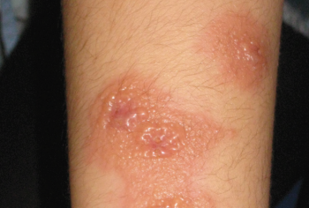 Bites and Stings: Arthropod bites – Pediatric Dermatology