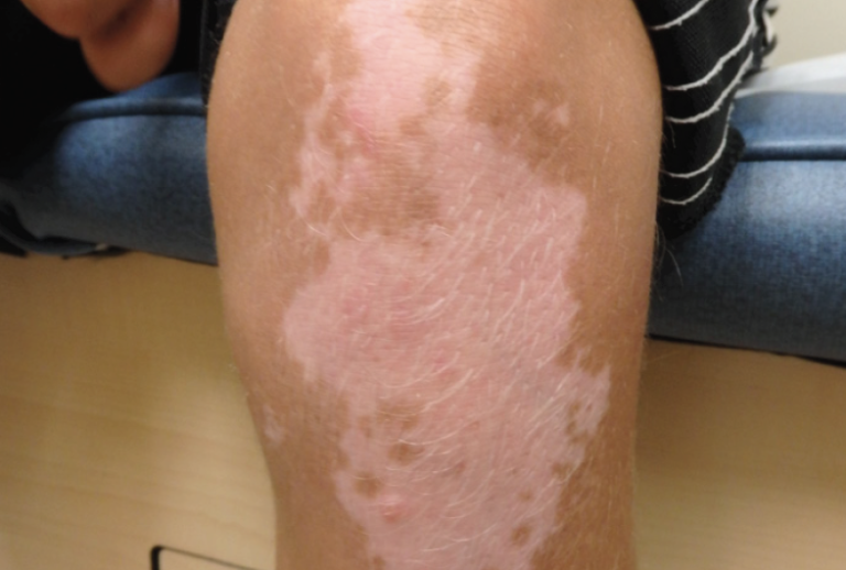 Hypopigmented and Depigmented Lesions: Vitiligo – Pediatric Dermatology