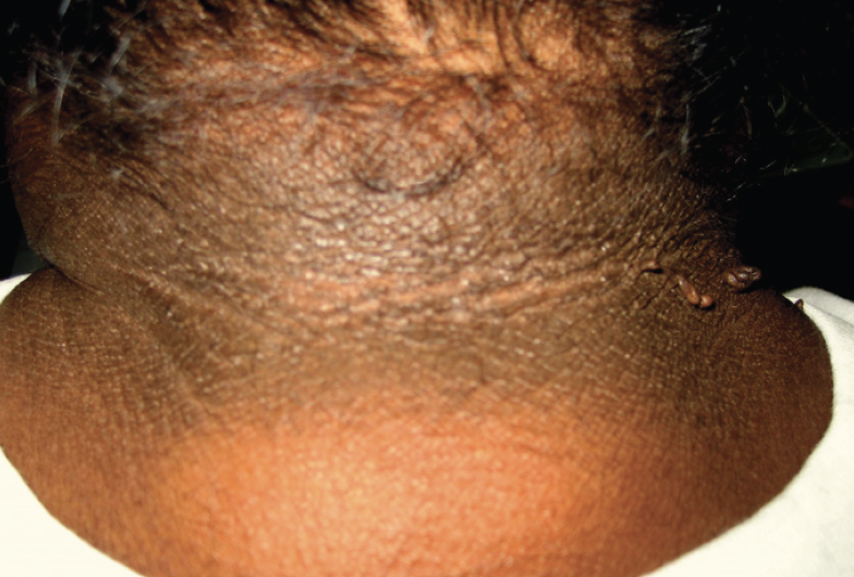 Hyperpigmented Lesions – Pediatric Dermatology