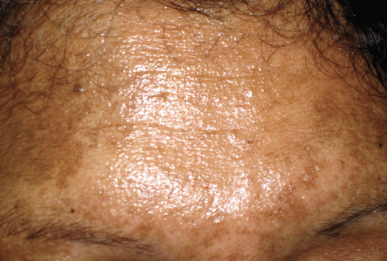 Hyperpigmented Lesions – Pediatric Dermatology