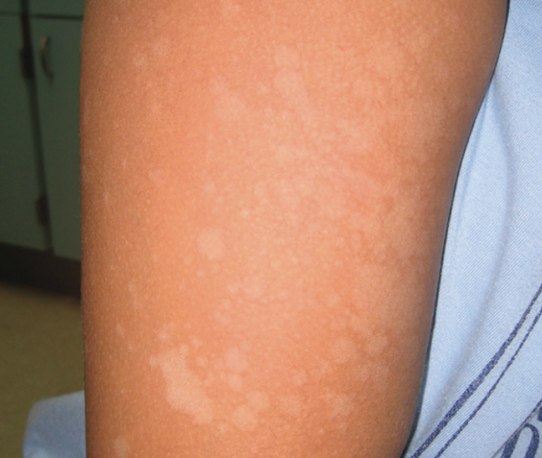Hyper- or Hypo-pigmented Lesions – Pediatric Dermatology