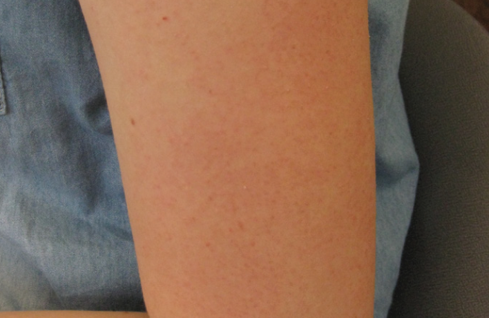 Scars: Keratosis Pilaris – Pediatric Dermatology
