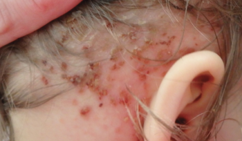 Langerhans Cell Histiocytosis – Pediatric Dermatology