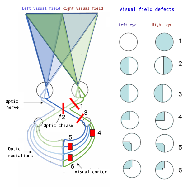 Visual Field Loss – Psycho-educational Assessments of Blind and Low ...